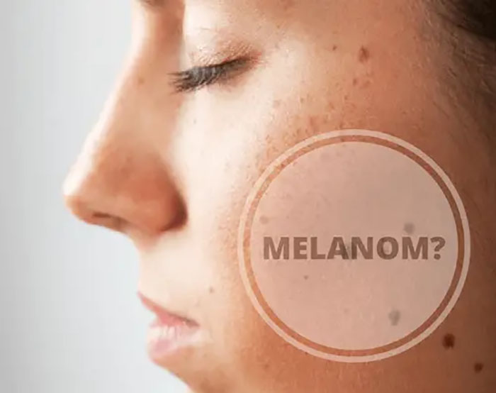 Broj oboljelih od melanoma u stalnom porastu - PCNEN